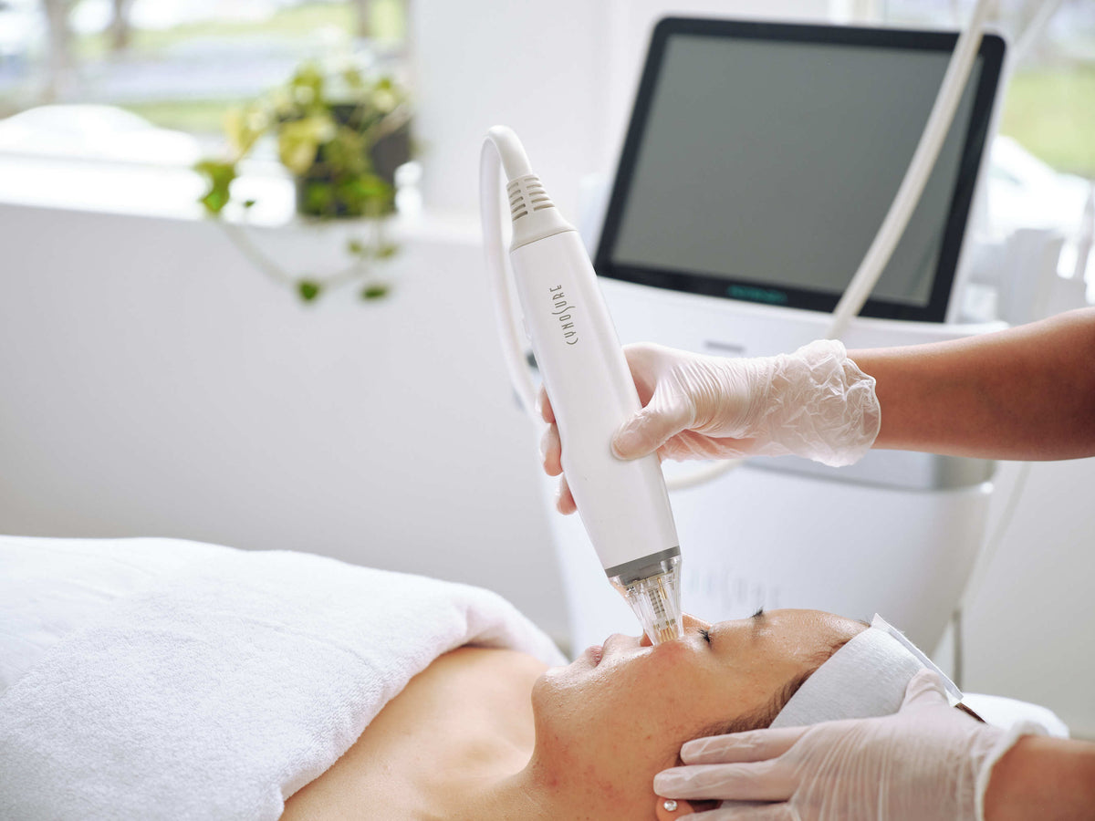 Potenza RF Micro Needling | Melbourne & Ballarat – Clinica Lase
